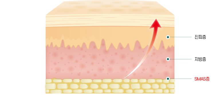 thread-lifting – UPIC CLINIC JP